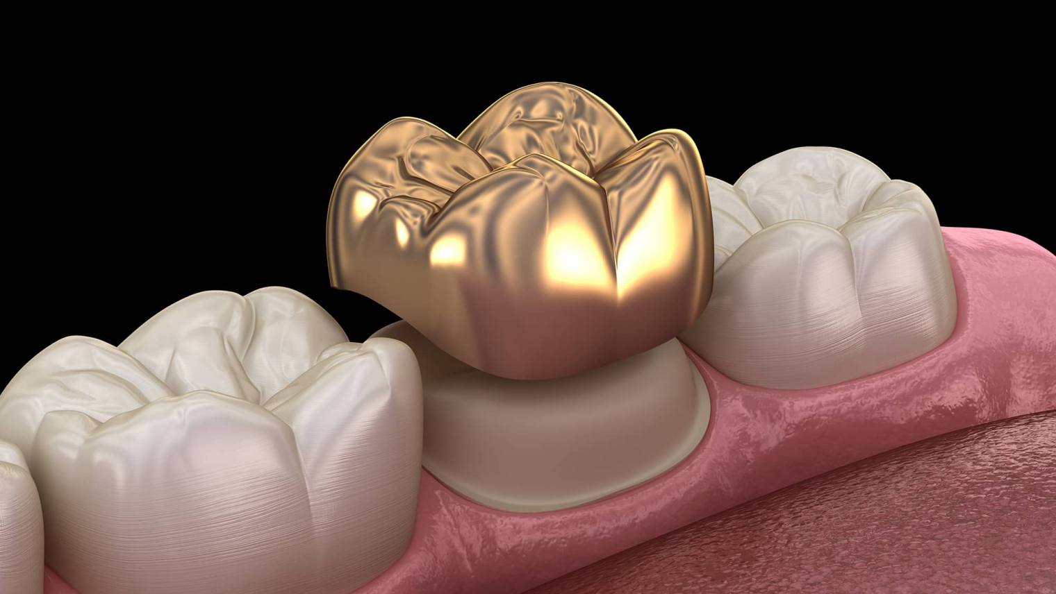 PFM & Full Gold Restorations – Luminous Dental Ceramics